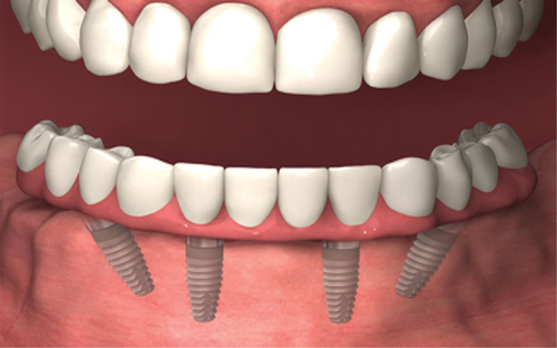 Dental Implants - Sedation and Implant Dentistry of Tehachapi with Jose ...